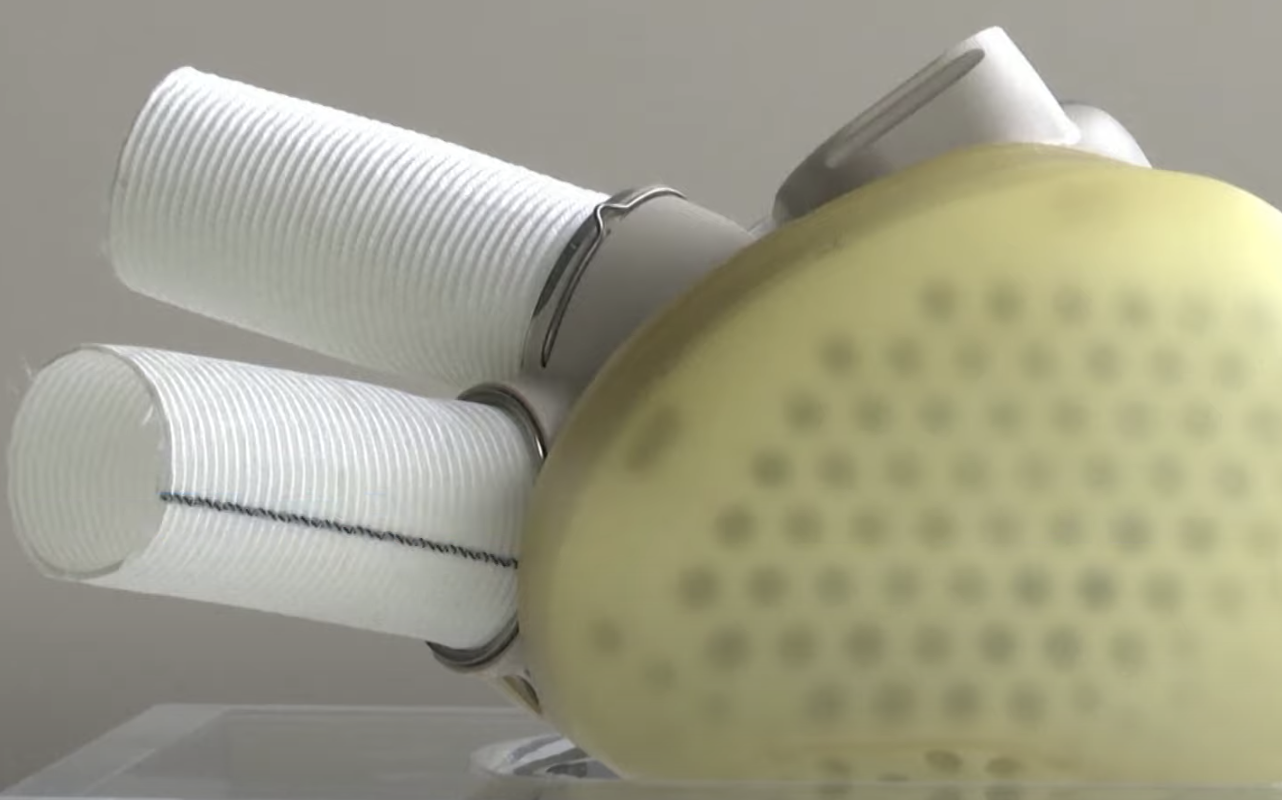 Primul Transplant Din Lume Cu Inimă Artificială A Fost Efectuat Cu ...